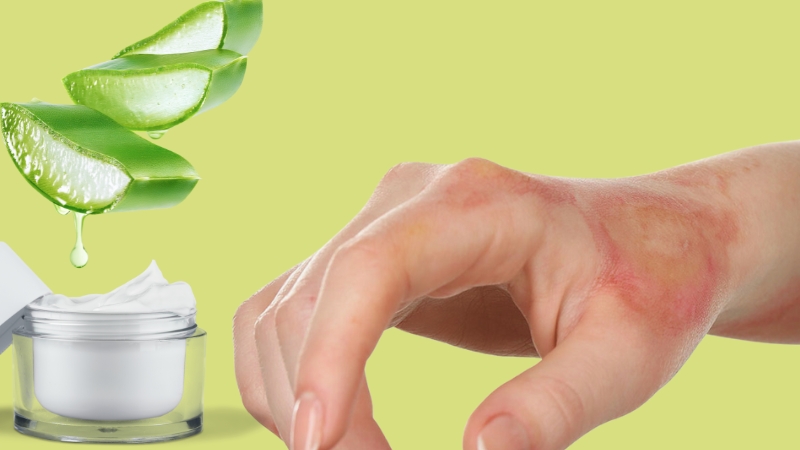 Šta je dobro za opekotine? Prirodne i medicinske opcije