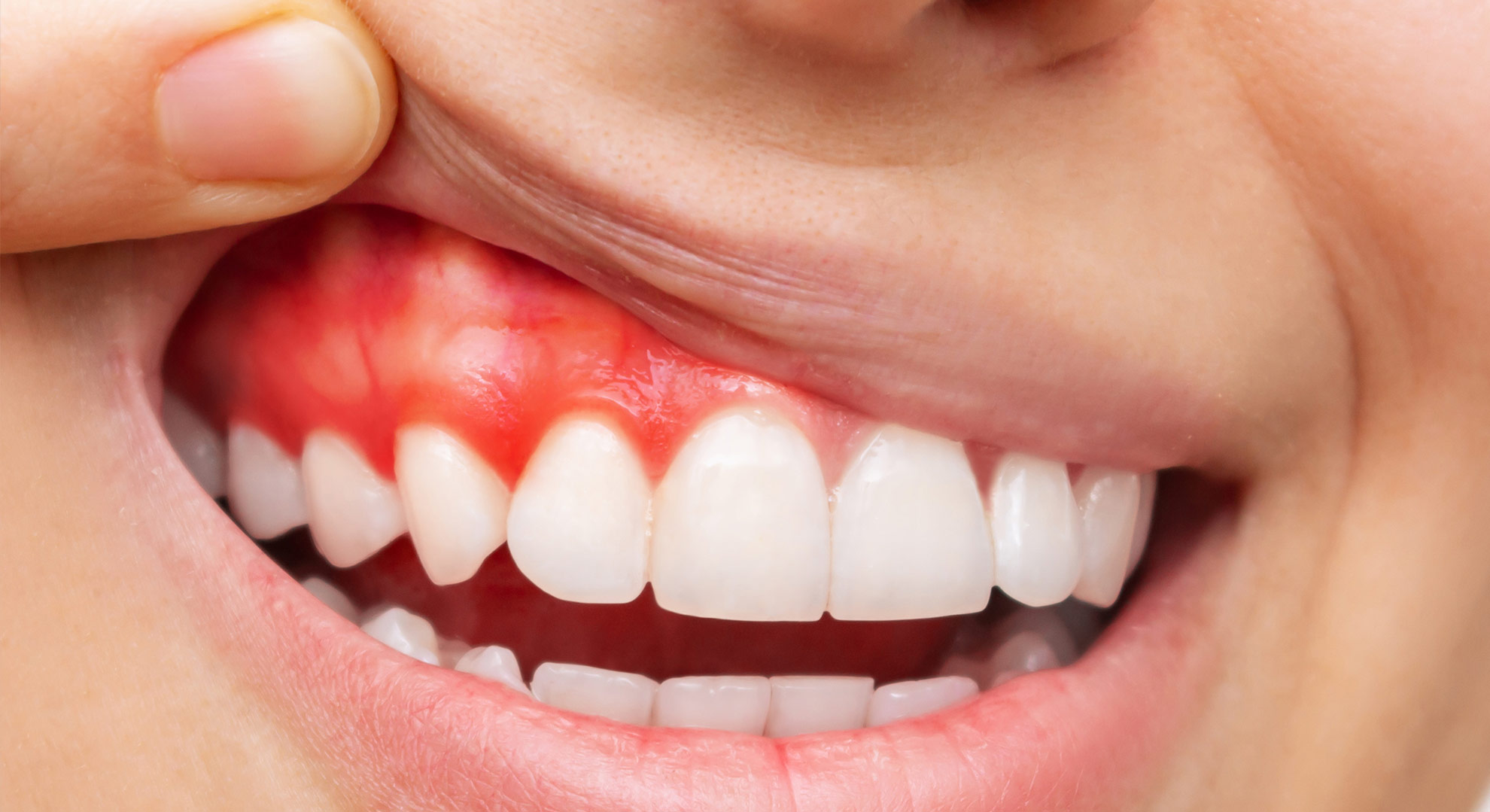 Upala desni - Koliko traje i kako je tretirati?
